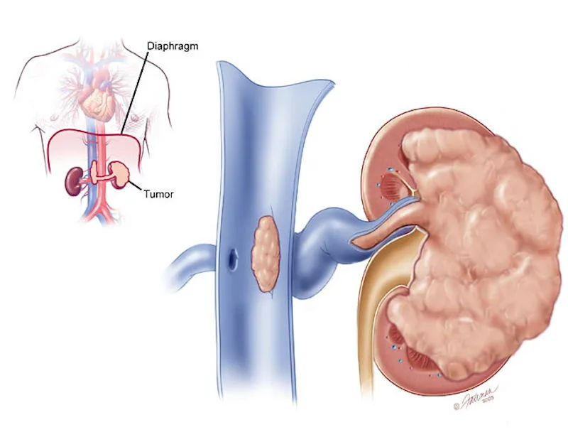 Kidney Cancer Tumor Removal